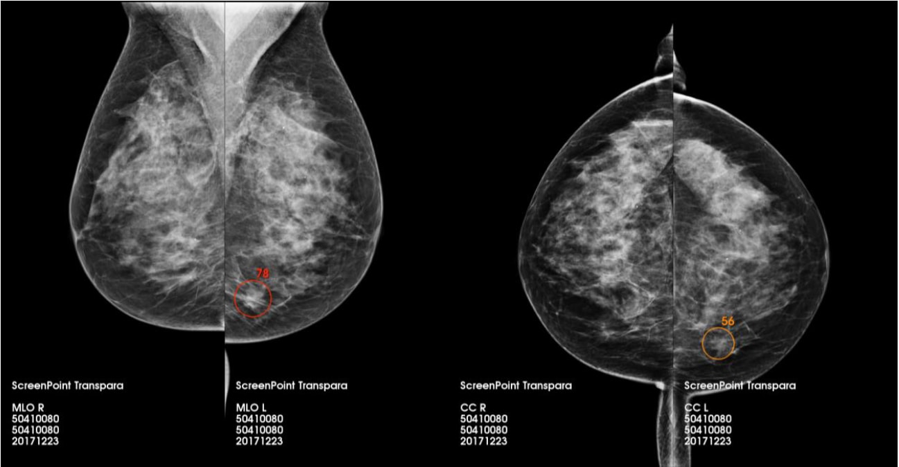 Transpara | Evolutive Medica